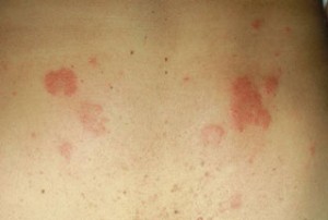 Urticaria - Dermatology Sydney