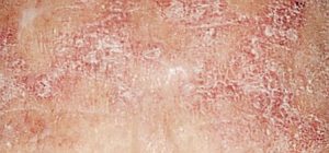 Causes of Actinic Keratoses - Dermatology Sydney